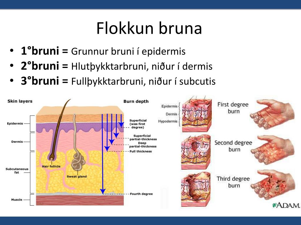 PPT - Brunaáverkar Leiðbeinandi : Jens Kjartansson PowerPoint ...