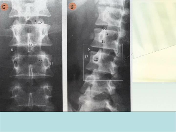 PPT - COLUMNA VERTEBRAL Huesos y Articulaciones PowerPoint Presentation ...