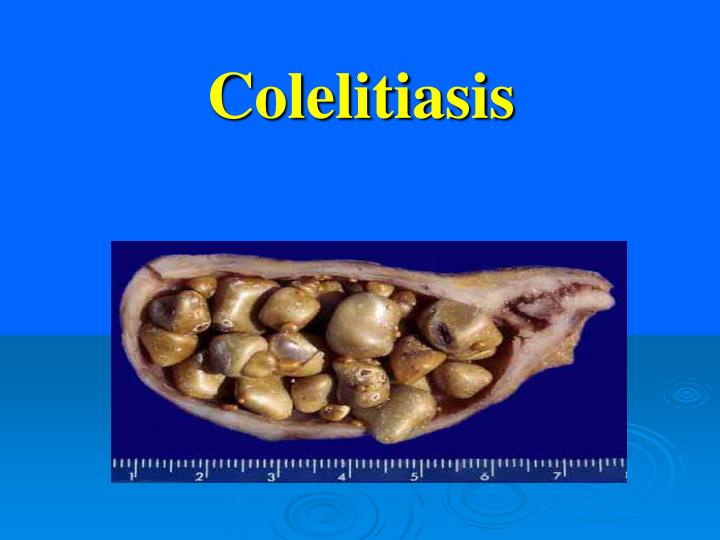 PPT - PATOLOGÍA BILIAR PowerPoint Presentation - ID:2267828