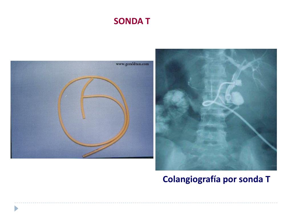 PPT - VESICULA Y VIAS BILIARES PowerPoint Presentation, free download ...