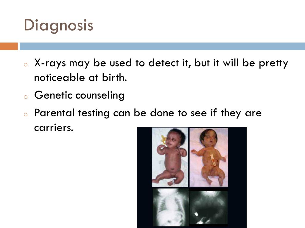 PPT - Spondyloepimetaphyseal Dysplasia ( Strudwick Type) PowerPoint ...