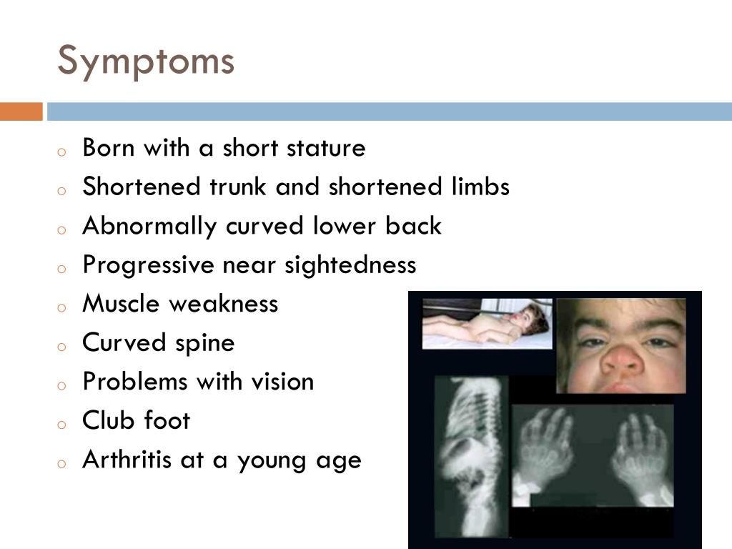 PPT - Spondyloepimetaphyseal Dysplasia ( Strudwick Type) PowerPoint ...