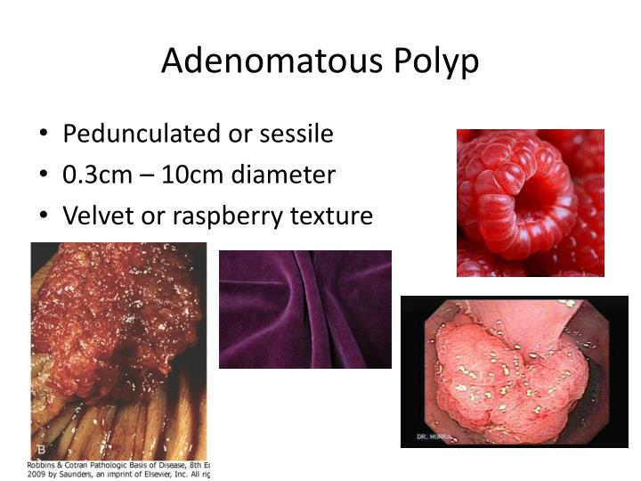 PPT - Neoplasia of Colon PowerPoint Presentation - ID:2271883