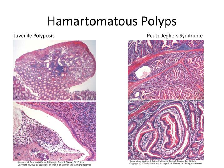 PPT - Neoplasia of Colon PowerPoint Presentation - ID:2271883