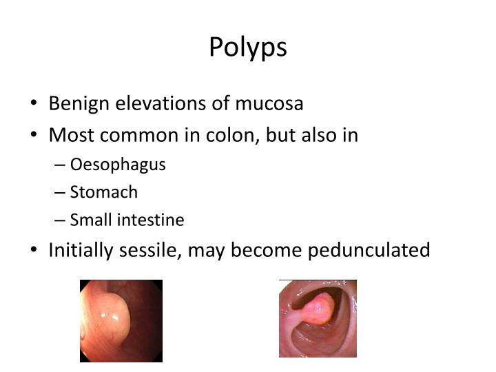 PPT - Neoplasia of Colon PowerPoint Presentation - ID:2271883