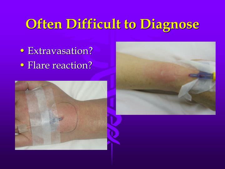 PPT - Extravasation PowerPoint Presentation - ID:2272151