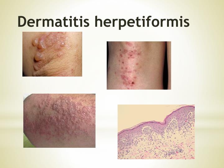 PPT - Celiac Disease PowerPoint Presentation - ID:2272240
