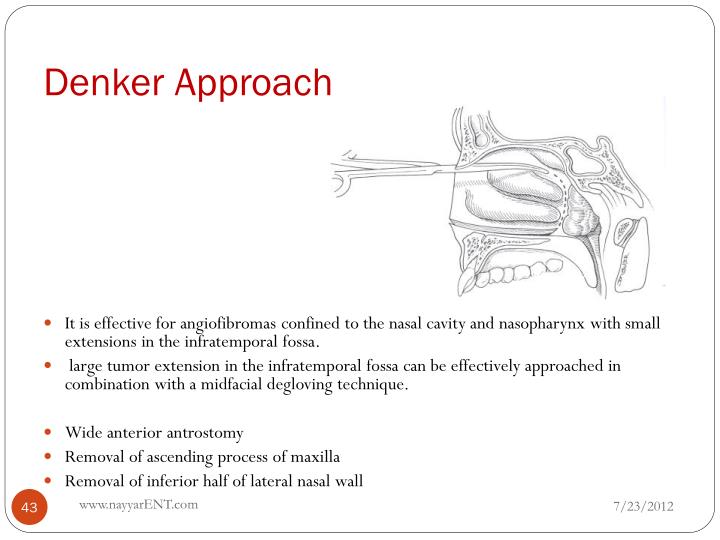 PPT - Juvenile Nasopharyngeal ANGIOFIBROMA PowerPoint Presentation - ID ...