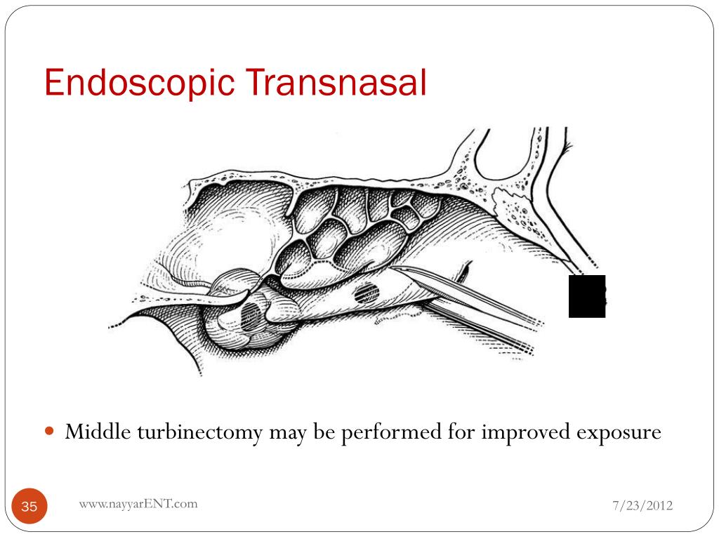 PPT - Juvenile Nasopharyngeal ANGIOFIBROMA PowerPoint Presentation ...