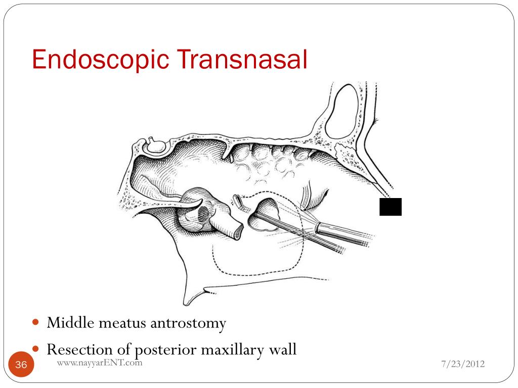 PPT - Juvenile Nasopharyngeal ANGIOFIBROMA PowerPoint Presentation ...