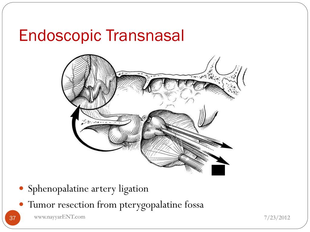 PPT - Juvenile Nasopharyngeal ANGIOFIBROMA PowerPoint Presentation ...