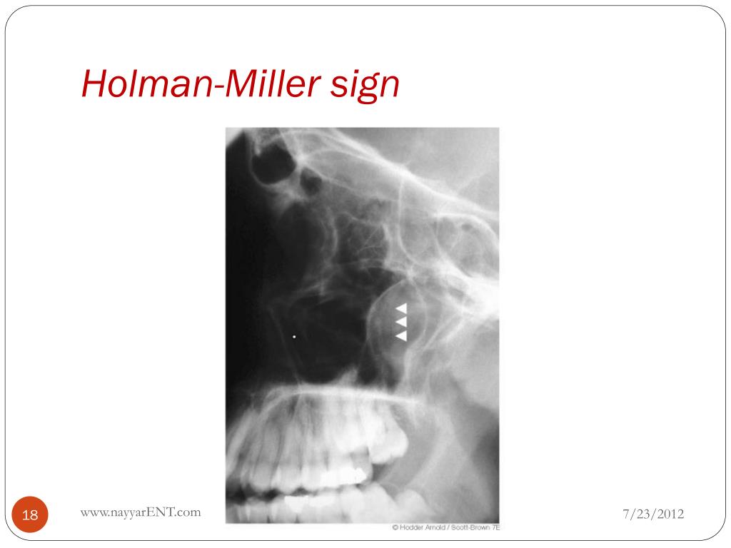 PPT - Juvenile Nasopharyngeal ANGIOFIBROMA PowerPoint Presentation ...