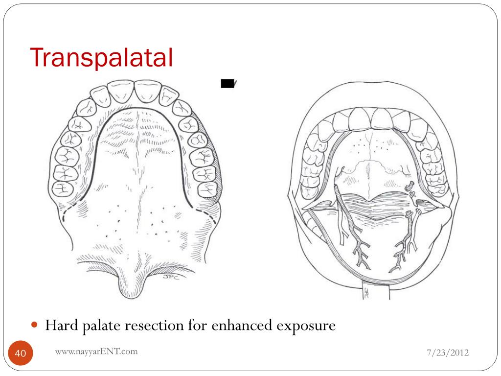 PPT - Juvenile Nasopharyngeal ANGIOFIBROMA PowerPoint Presentation ...