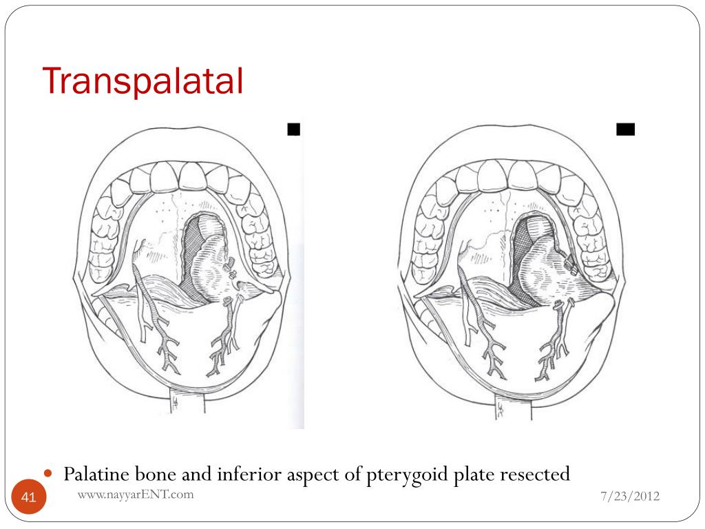 PPT - Juvenile Nasopharyngeal ANGIOFIBROMA PowerPoint Presentation ...