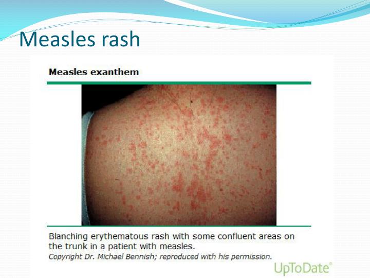 PPT - Measles and Other Childhood Exanthems PowerPoint Presentation ...