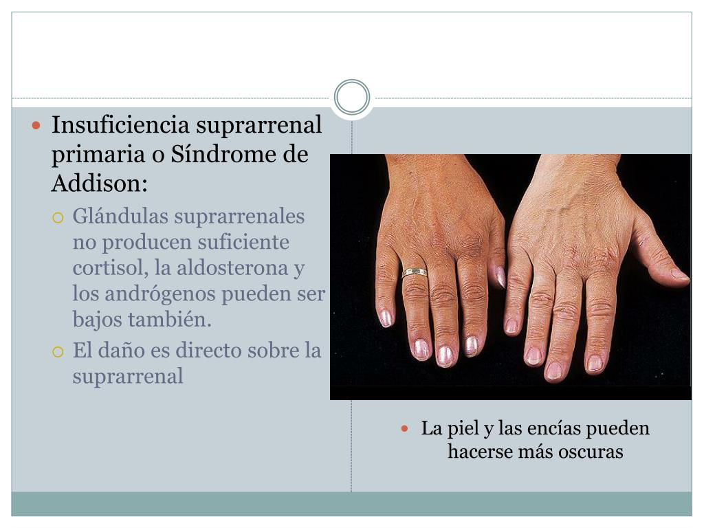 PPT - Síndrome de Addison o insuficiencia suprarrenal primaria ...
