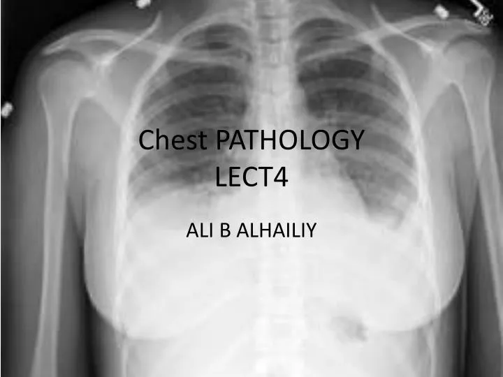 PPT - Chest PATHOLOGY LECT4 PowerPoint Presentation, free download - ID ...