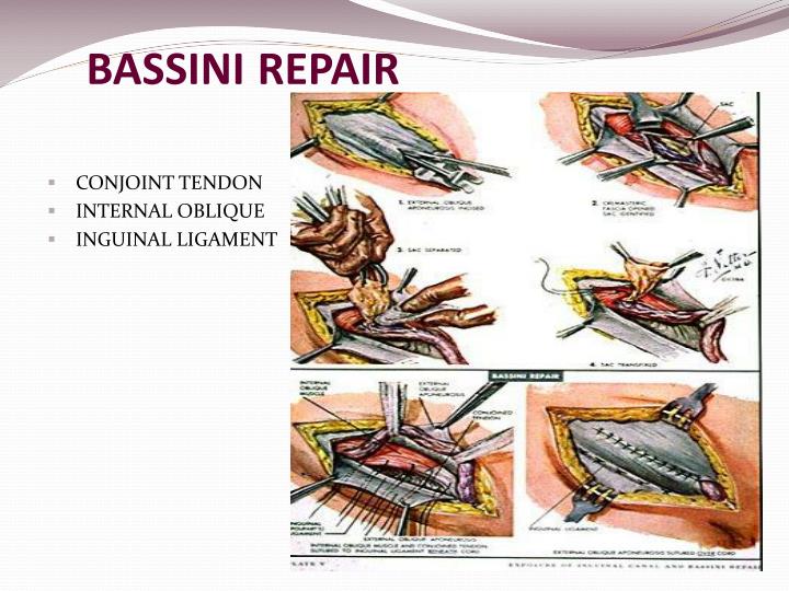 PPT - ABDOMINAL HERNIAS PowerPoint Presentation - ID:2275972