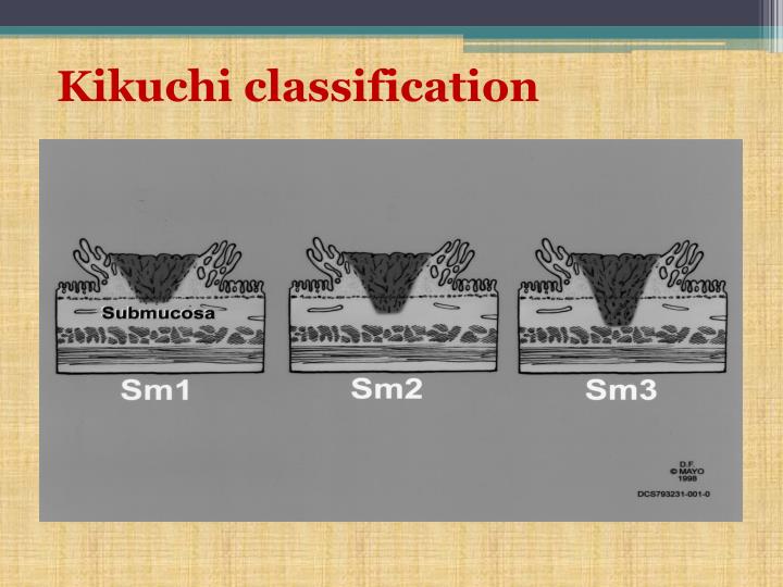 PPT - Rectal cancer PowerPoint Presentation - ID:2276176