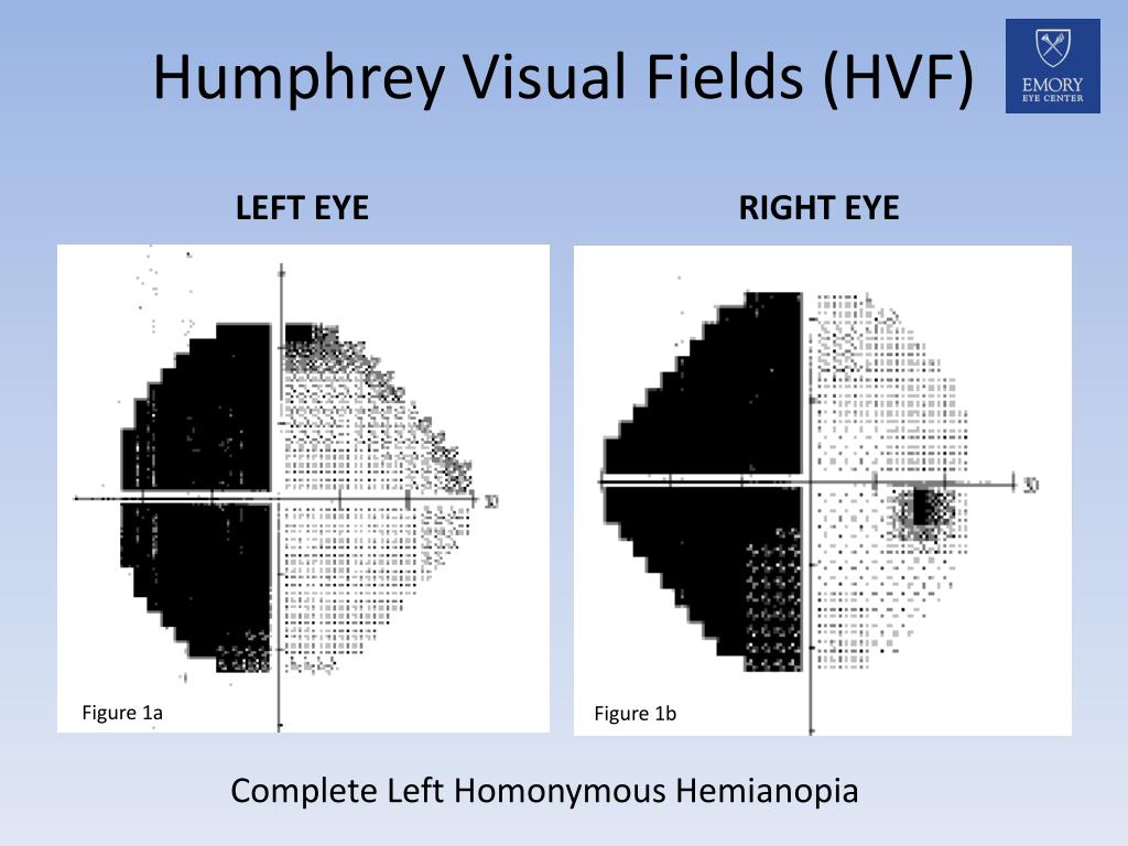 PPT - Kristen Hudson, MD Valerie Biousse , MD PowerPoint Presentation ...