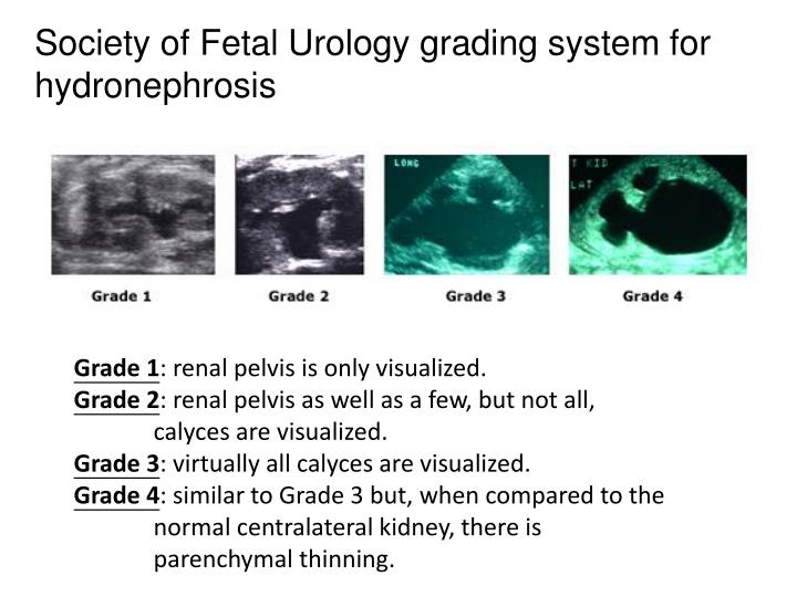 PPT - ANTENATAL HYDRONEPHROSIS PowerPoint Presentation - ID:2276979