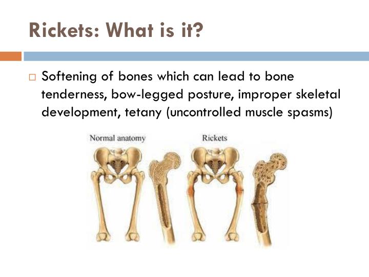 PPT - SKELETAL DISEASES NOTES PowerPoint Presentation - ID:2277483