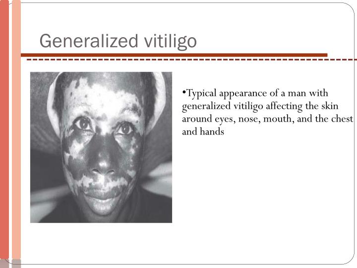 PPT - Vitiligo, Depigmentation and Monobenzone PowerPoint Presentation ...