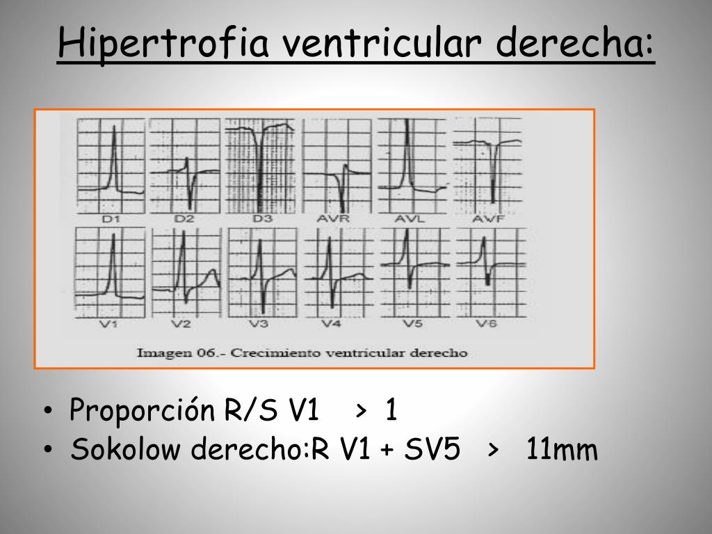 PPT - APUNTES BÁSICOS DE ELECTROCARDIOGRAFÍA PowerPoint Presentation ...