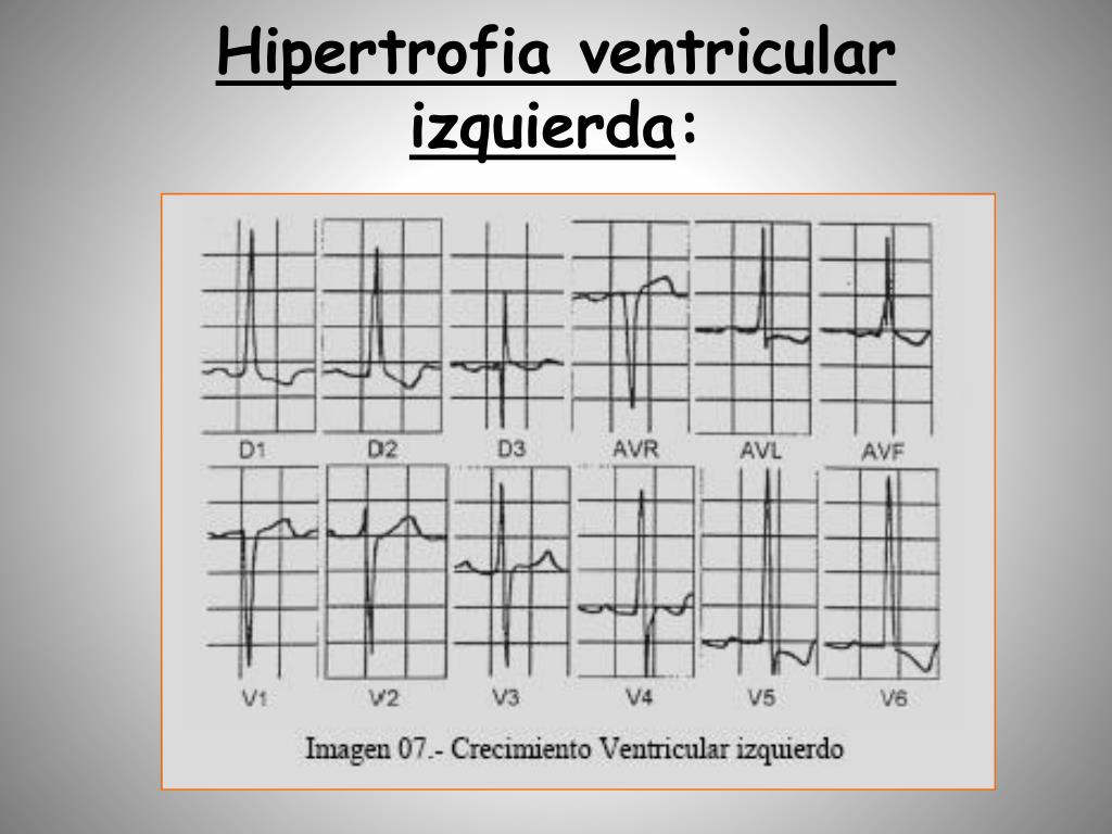 PPT - APUNTES BÁSICOS DE ELECTROCARDIOGRAFÍA PowerPoint Presentation ...