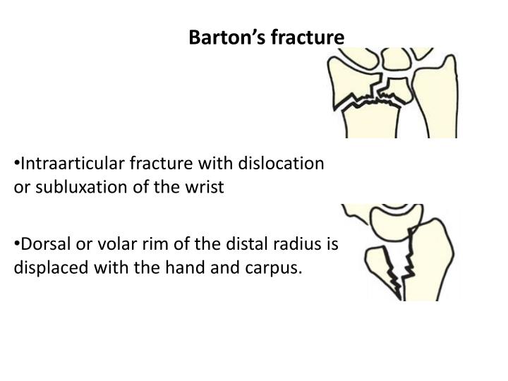 PPT - Common Adult Fractures PowerPoint Presentation - ID:2280629