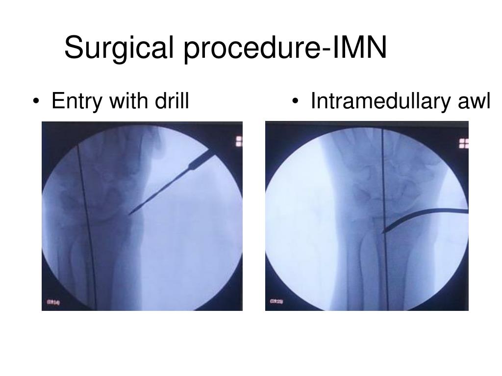 PPT - Mark VanDer Kaag 1 , Ajmal Ikram 2 1 Orthopaedic Registrar ...