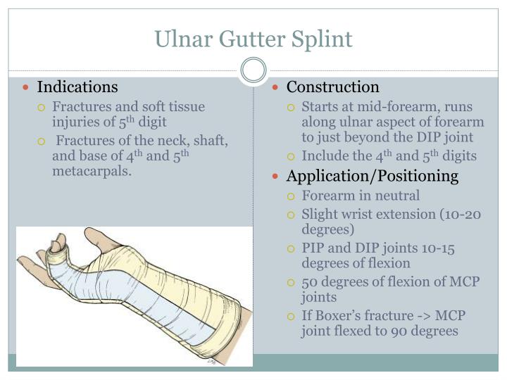 Ulnar Gutter Splint Cast Ulnar Gutter Splint Cast