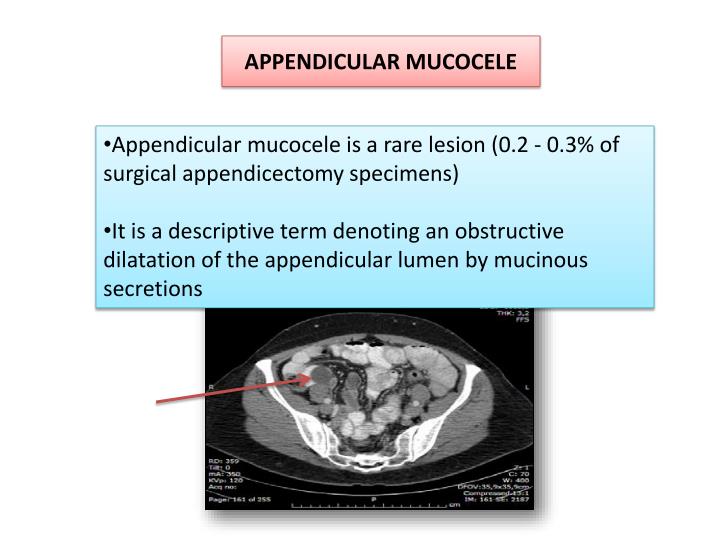 PPT - RIGHT ILIAC FOSSA MASS PowerPoint Presentation - ID:2282476
