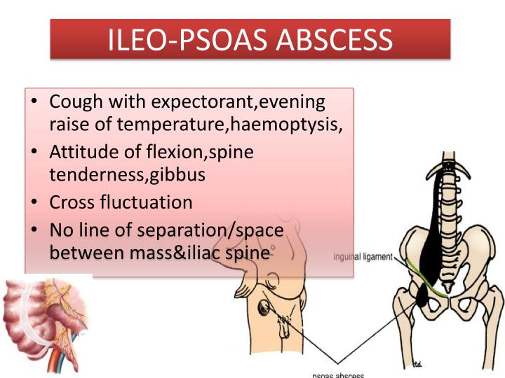 PPT - RIGHT ILIAC FOSSA MASS PowerPoint Presentation - ID:2282476
