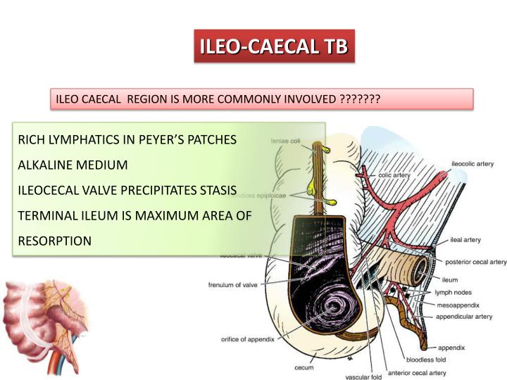 PPT - RIGHT ILIAC FOSSA MASS PowerPoint Presentation - ID:2282476