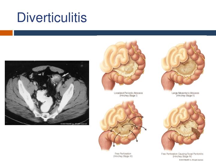 PPT - Acute surgical conditions PowerPoint Presentation - ID:2282683