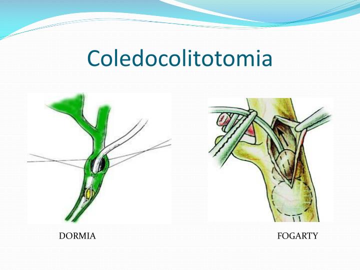 PPT - COMPLICANZE DELLA COLELITIASI PowerPoint Presentation - ID:2282750