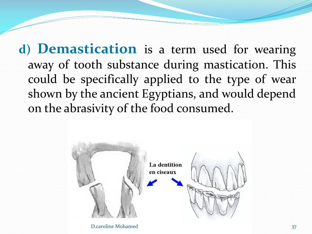 PPT - Tooth wear: aetiology , prevention, clinical implication ...