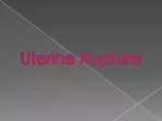 PPT - Uterine Rupture PowerPoint Presentation - ID:2283868