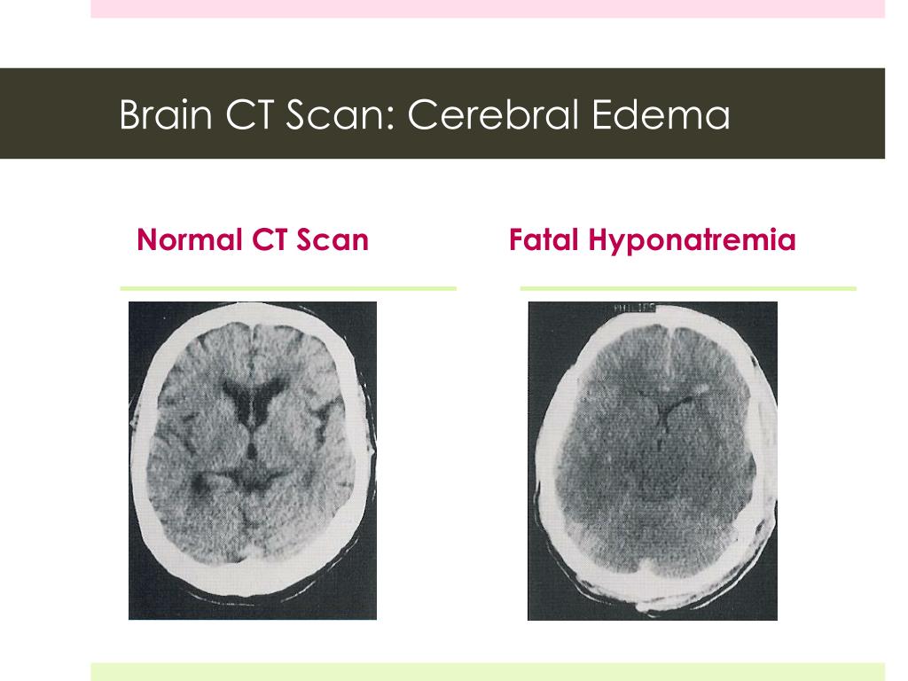 Hyponatremia Cerebral Edema Hyponatremia Cerebral Edema