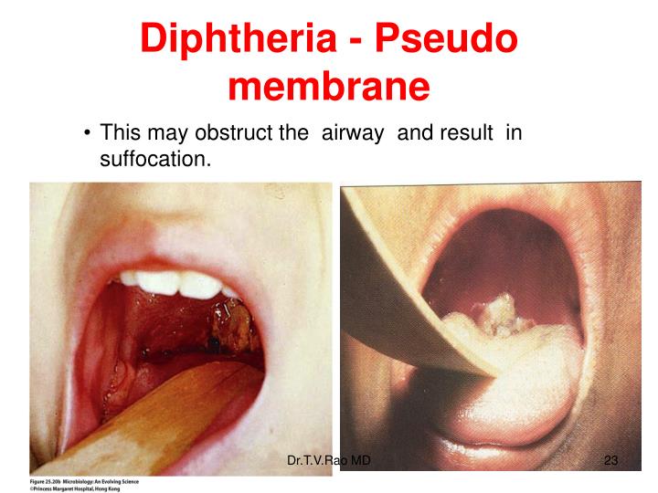 PPT - Diphtheria Corynebacterium diphtheria Kleb’s – Loffler's bacilli ...