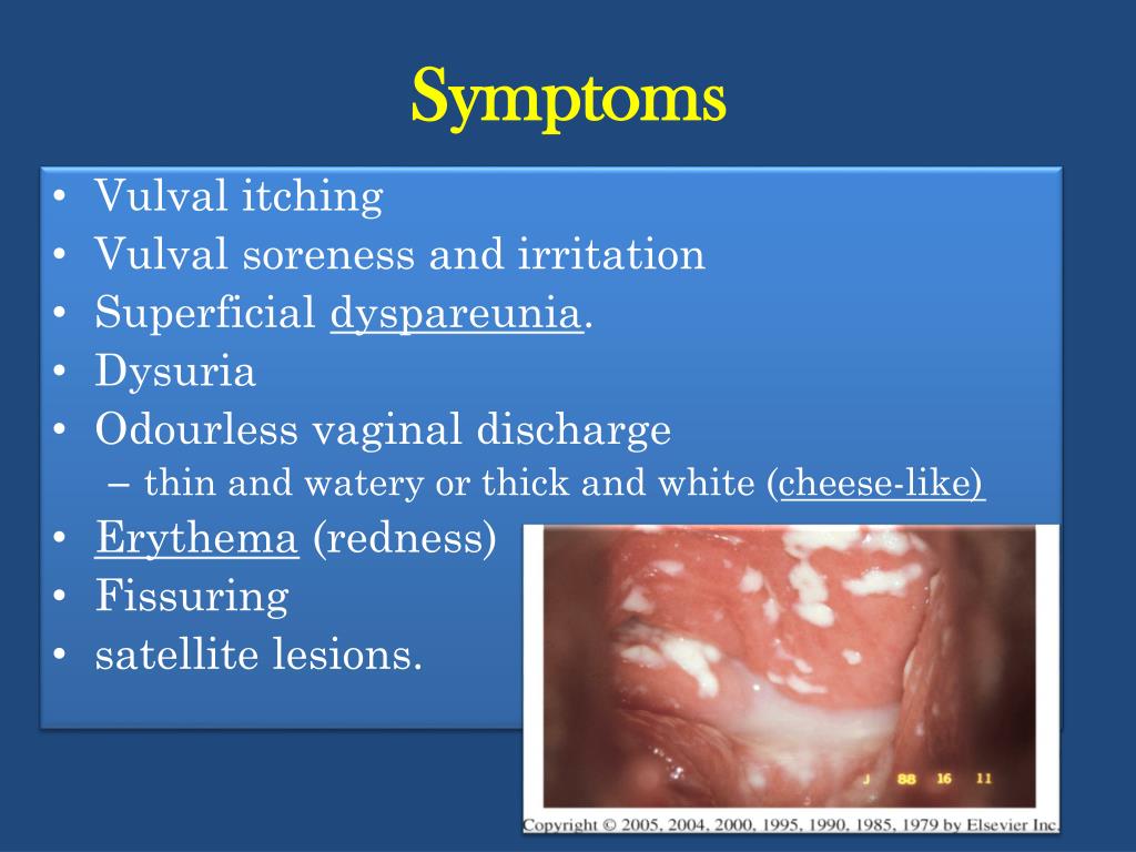 PPT - Candida infection T ricpmonas vaginalis Bacterial vaginosis ...