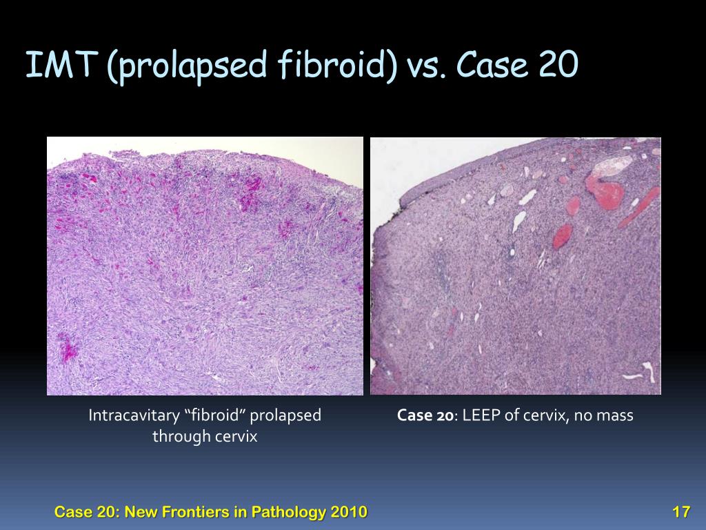 PPT - Case 20: 46 yo Female, ASCUS PAP, + for High-risk HPV PowerPoint ...