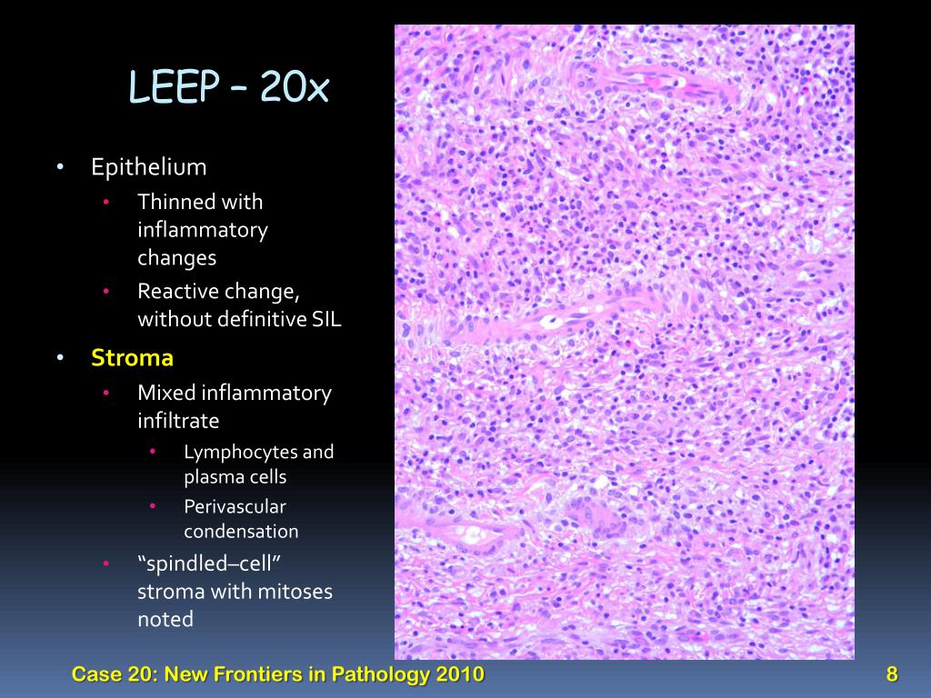 PPT - Case 20: 46 yo Female, ASCUS PAP, + for High-risk HPV PowerPoint ...