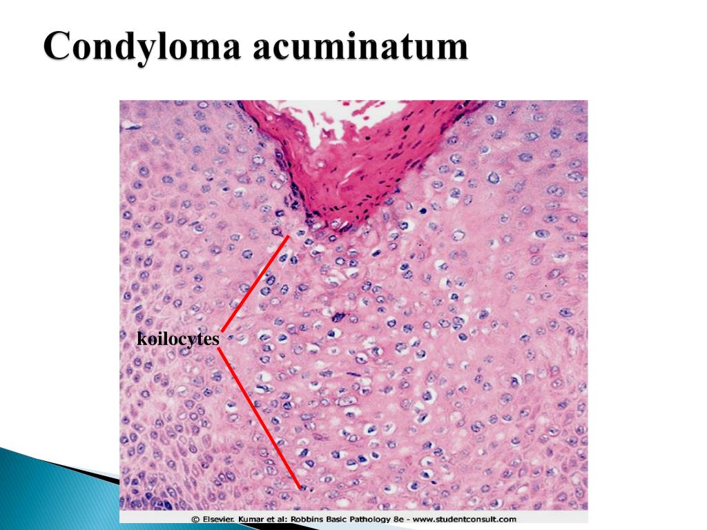 PPT - Pathology of the lower female genital tract PowerPoint ...