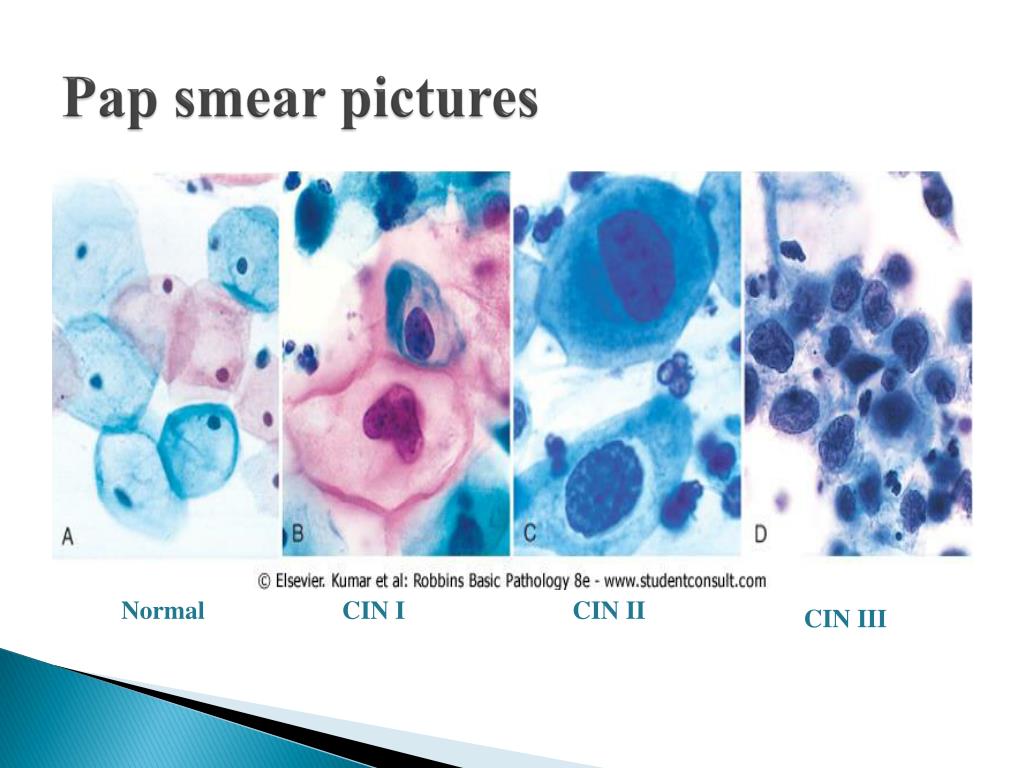 PPT - Pathology of the lower female genital tract PowerPoint ...