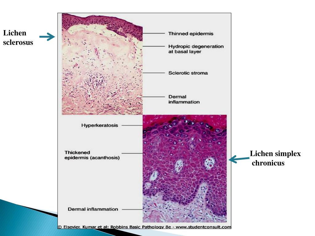 PPT - Pathology of the lower female genital tract PowerPoint ...