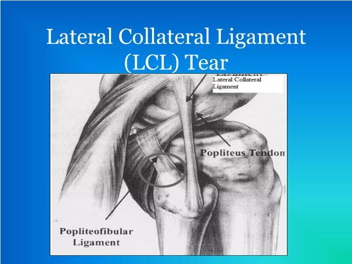 PPT - Lateral Collateral Ligament (LCL) Tear PowerPoint Presentation ...