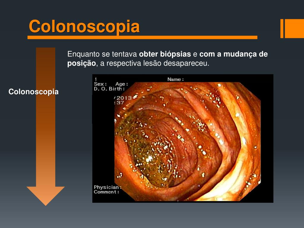 PPT - Invaginação Intestinal de Pólipo Fibróide Inflamatório do Íleon ...