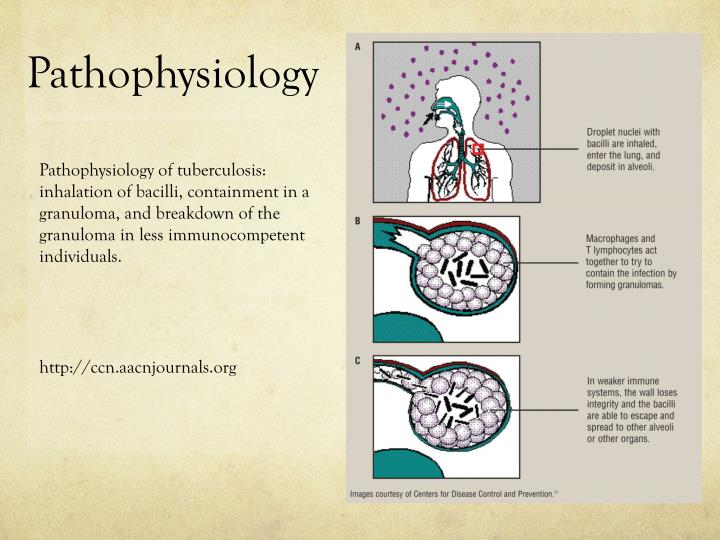 PPT - TUBERCULOSIS in Children PowerPoint Presentation - ID:2290012